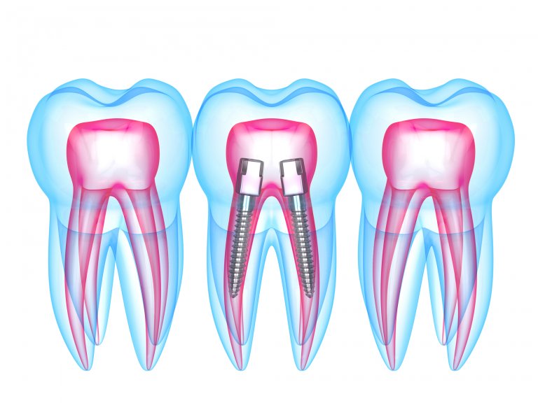 Perno Dental Precios: Tarifas actualizada [ 2025 ]