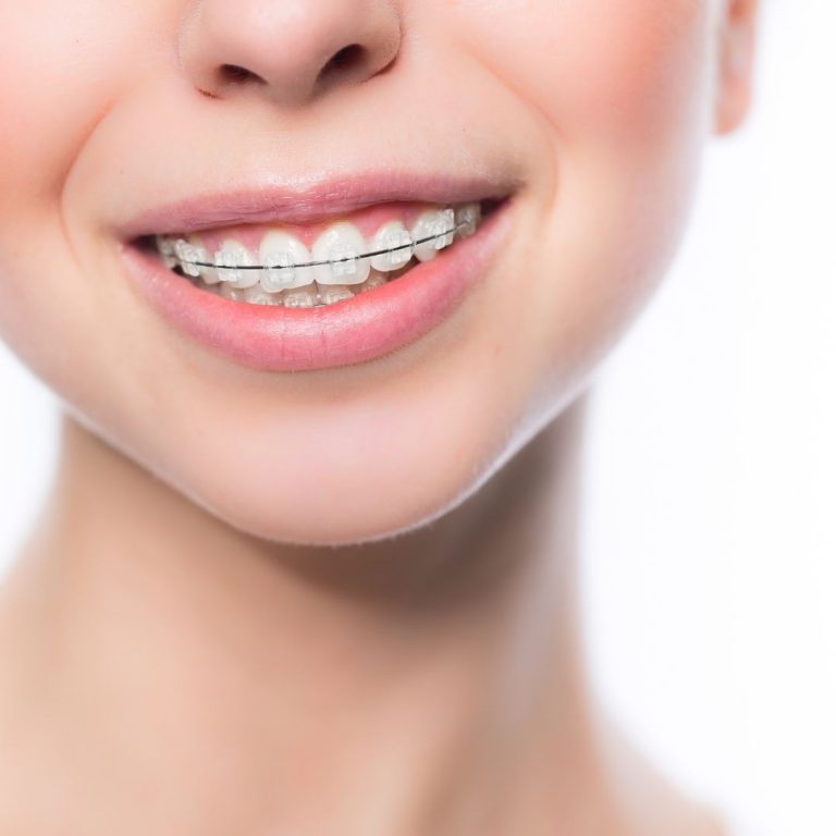 Invisalign o brackets: ¿cuál es el mejor tratamiento de ortodoncia?