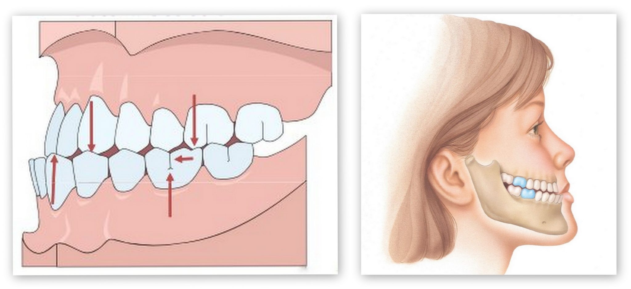 Mentonera de ortodoncia y máscara facial: qué son y para qué sirven