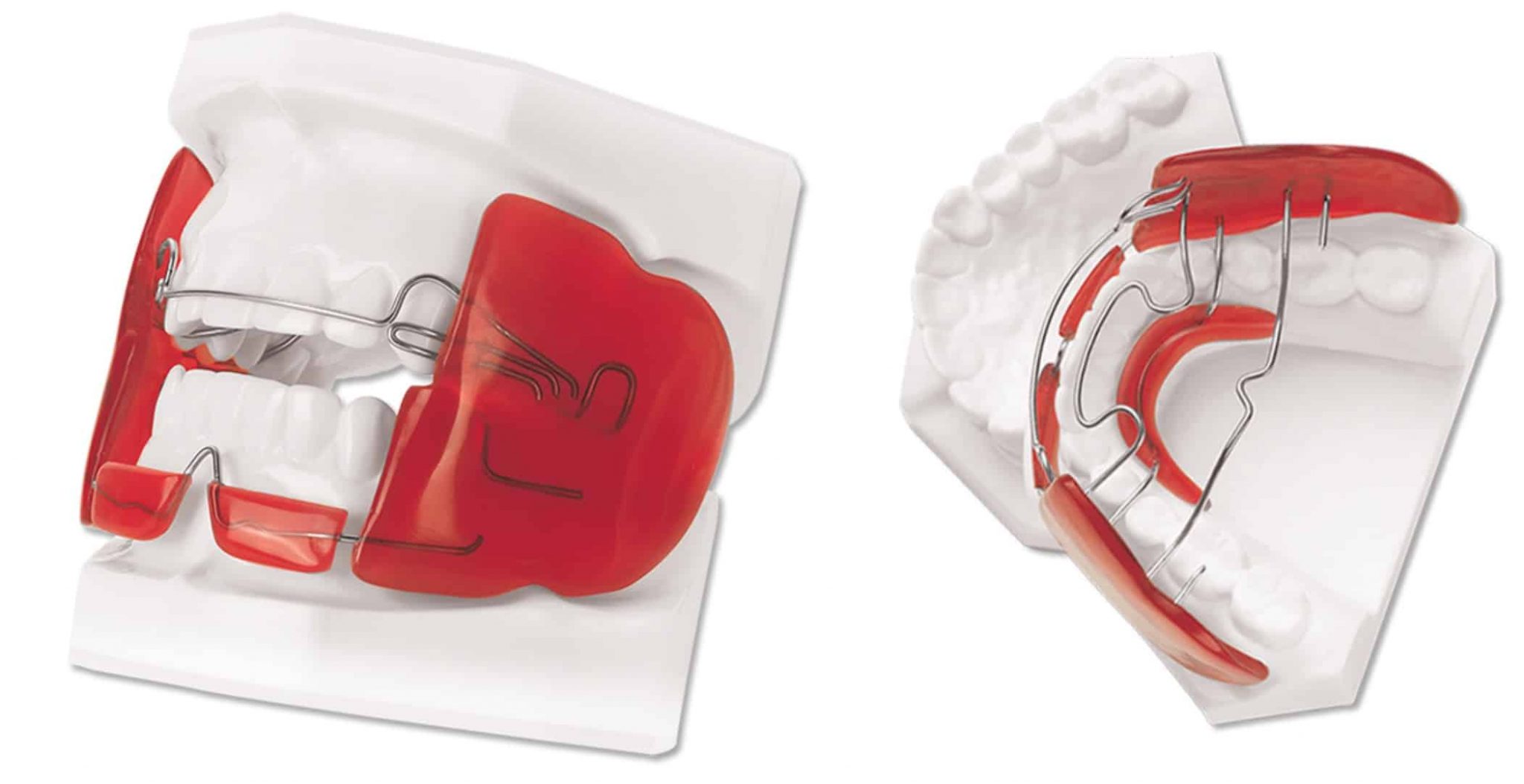 Aparato de Frankel: qué es y para qué se usa en ortodoncia