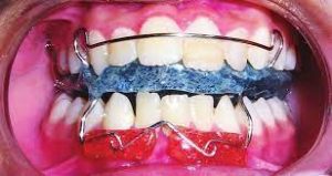 Aparato de Frankel: qué es y para qué se usa en ortodoncia