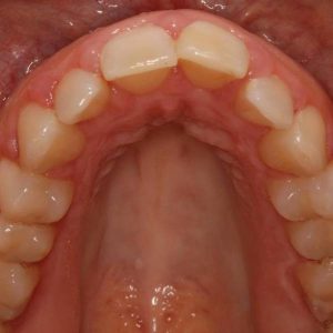 Paladar ojival o paladar estrecho: cuándo y cómo se puede corregir