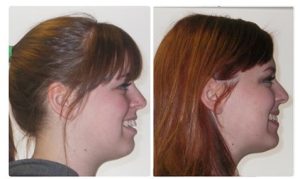 ¿Cómo cambia el aspecto de los labios y de la boca con los brackets?