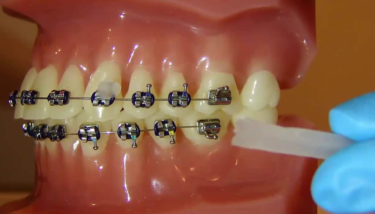 Cera dental para ortodoncia: ¿qué es y cómo se usa?