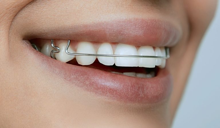 Placa de Hawley en ortodoncia: ¿por qué es tan importante?