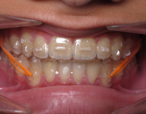 Gomas en Invisalign: qué son, para qué sirven y cómo ponérselas