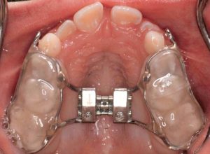 Qué hace un disyuntor dental y cuánto tiempo debe usarse