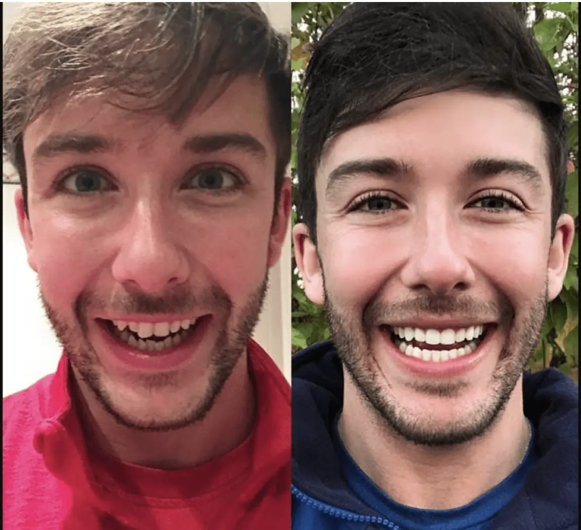 Spark vs Invisalign: ¿qué tipo de ortodoncia invisible es mejor?