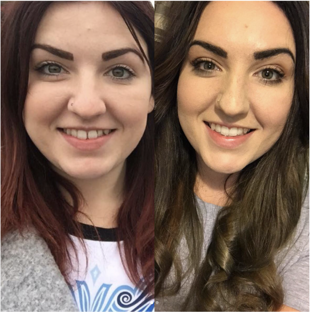 Invisalign Full: precio en España, ventajas y cómo funciona