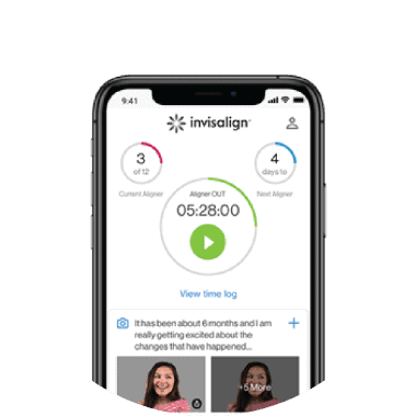 My Invisalign App: qué es y para qué sirve la aplicación móvil