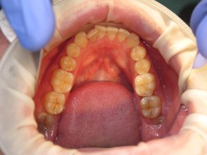 Torus mandibular: tipos de torus y por qué aparecen