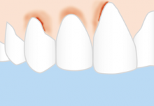 Activated Charcoal for Teeth Whitening: How to Use It - Dentaly.org