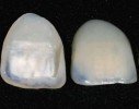 Teeth Filing: Smile Makeover with Tooth Countouring - Dentaly.org