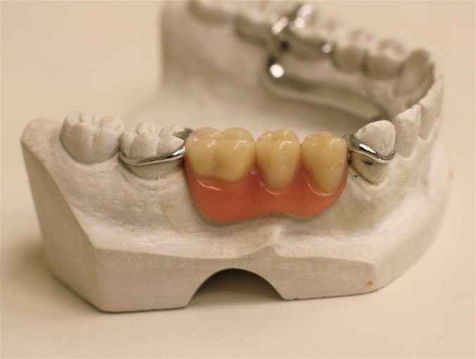 Dental Bridge Cost Estimate, Types, and Pros and Cons - Dentaly.org