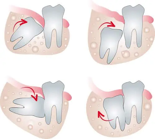 Wisdom Teeth: Find Your Answers on Symptoms and Removal Here - Dentaly.org