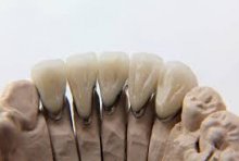 Emax Crowns Price, Materials, and Pros and Cons