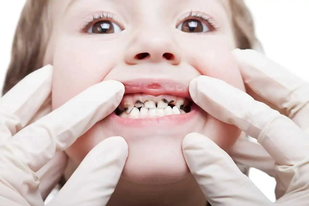 What is a Cavity? Tooth Decay Symptoms, Causes & Treatments - Dentaly.org