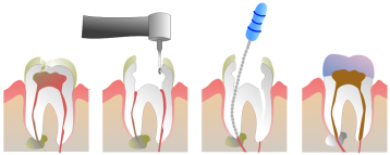 Tooth Extraction Near Me: Costs and Pain Management - Dentaly.org
