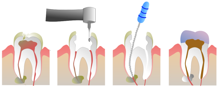 Tooth Extraction Near Me: Costs and Pain Management - Dentaly.org