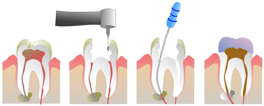Tooth Extraction Near Me: Costs and Pain Management - Dentaly.org