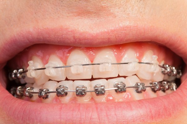 Ceramic Braces: What Do They Cost and Should You Get Them? - Dentaly.org