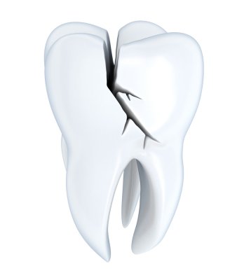 Chipped Tooth Repair: Treatment Costs and Pain Relief - Dentaly.org