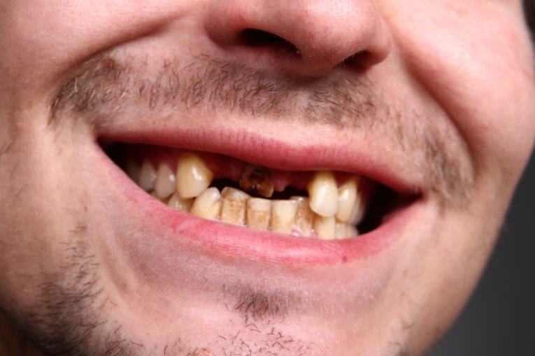 G4 by Golpa: Implant Cost, Locations, Recovery, and More - Dentaly.org