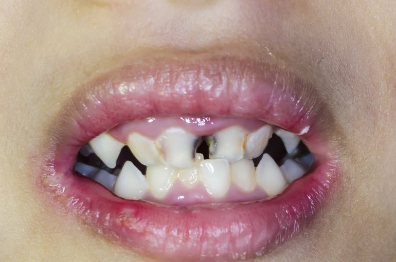 Children's Oral Health: Tooth Decay and Prevention - Dentaly.org