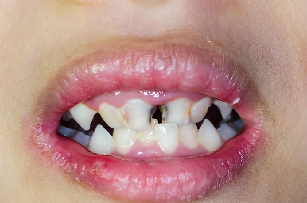 Children's Oral Health: Tooth Decay and Prevention - Dentaly.org