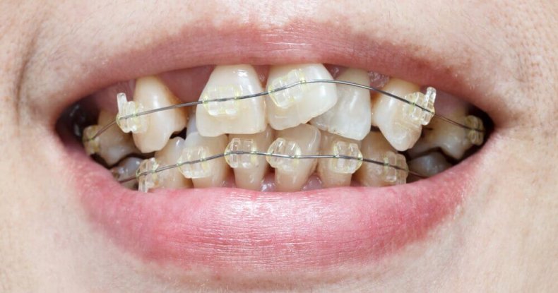 Braces & Teeth Straightening - Dentaly.org