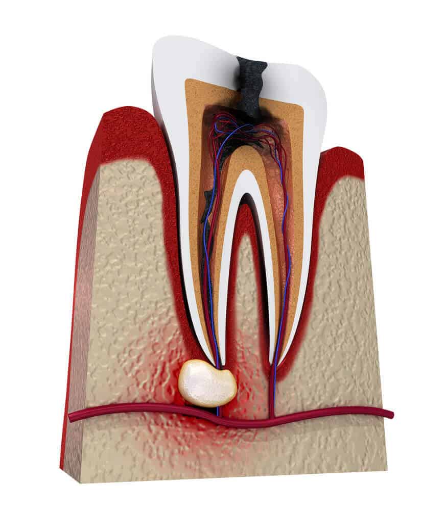What is Pulpitis? Symptoms, Treatment, and Pain Relief - Dentaly.org