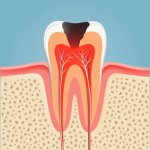 What is Pulpitis? Symptoms, Treatment, and Pain Relief - Dentaly.org
