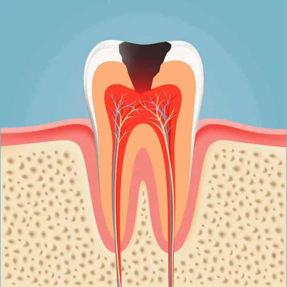 What is Pulpitis? Symptoms, Treatment, and Pain Relief - Dentaly.org