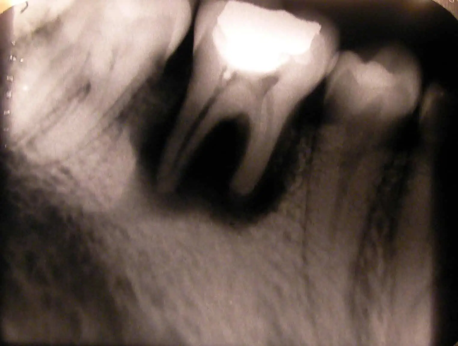 Tooth Resorption: Is It Dangerous and Why Should You Care? - Dentaly.org