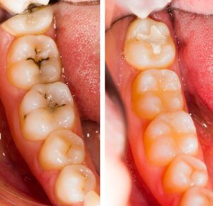 Filling Fell Out? Fix and Prevent Lost Restorations - Dentaly.org