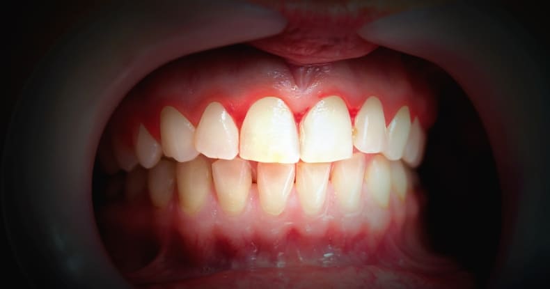 Bleeding Gums: Causes, Treatments, Cures and Prevention