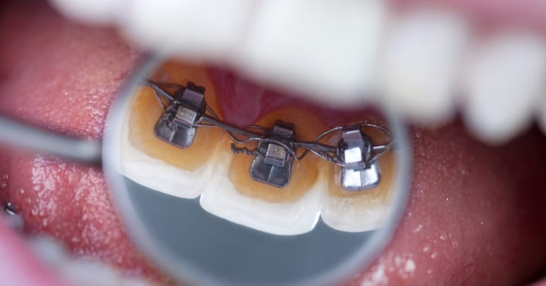 What are Brius Braces? Find Out About Cost and Treatment Time - Dentaly.org