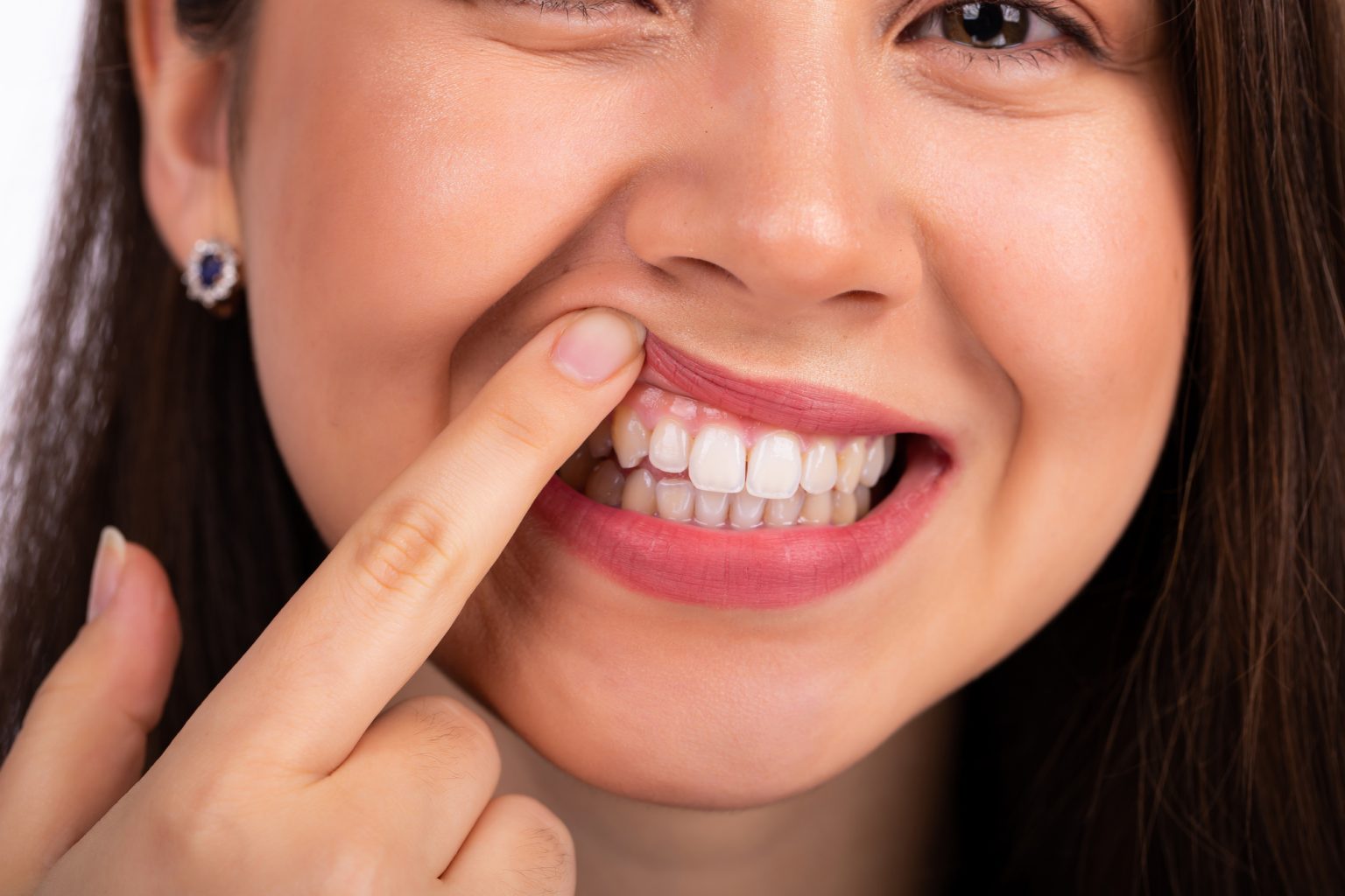 Gummy Smile: Why Are My Gums Big and What Can I Do About It? - Dentaly.org