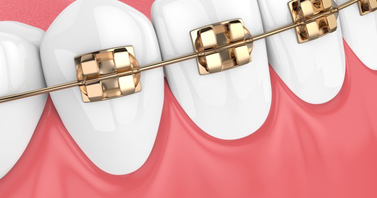 Gold Braces for Teeth: Costs, Side Effects, Benefits and More - Dentaly.org