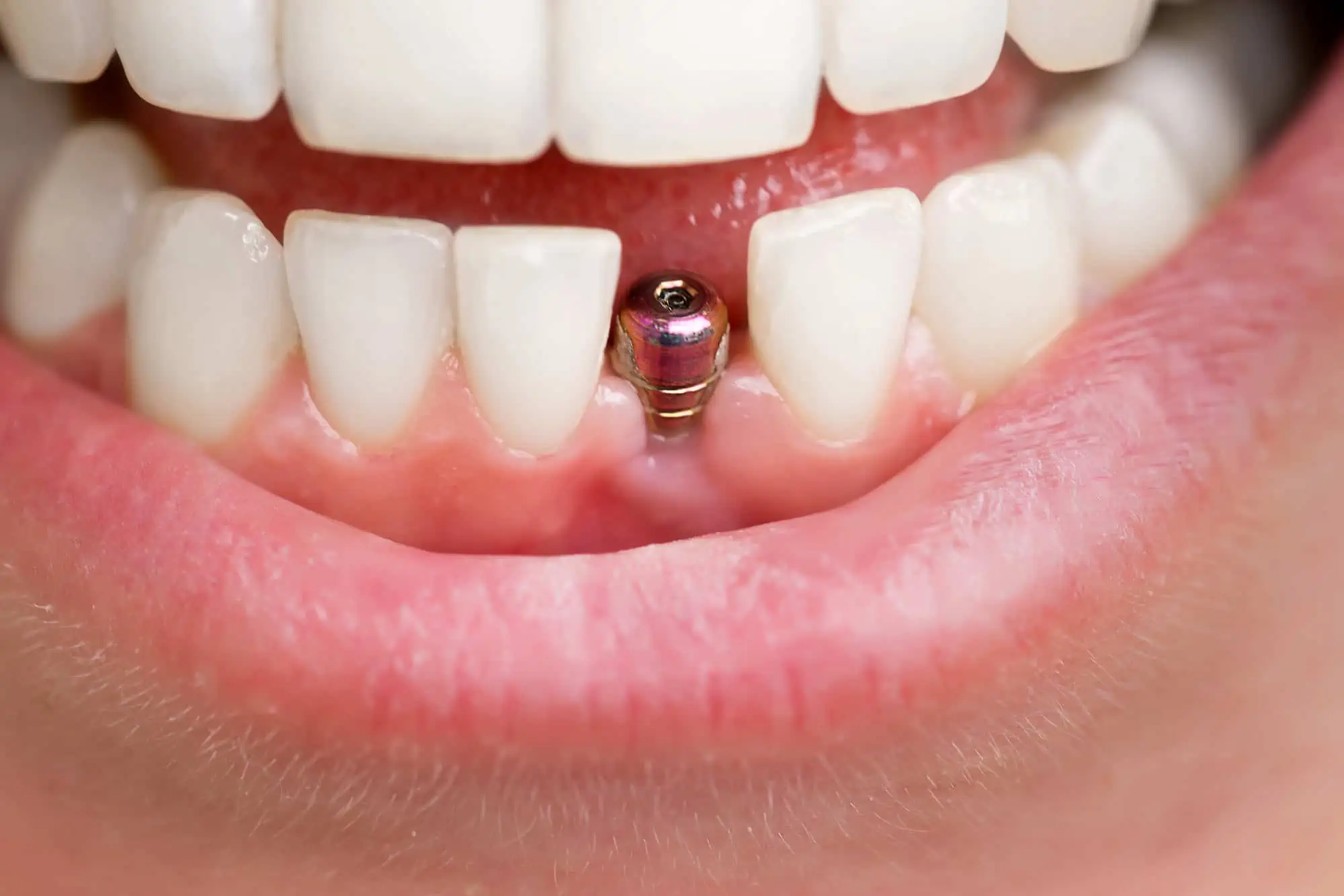 Dental Implant Showing Through Gum: What Should You Do? - Dentaly.org