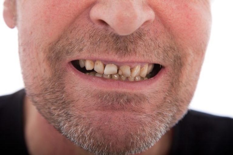 Black Stains on Teeth: How To Get Rid of Black Spots on Teeth?