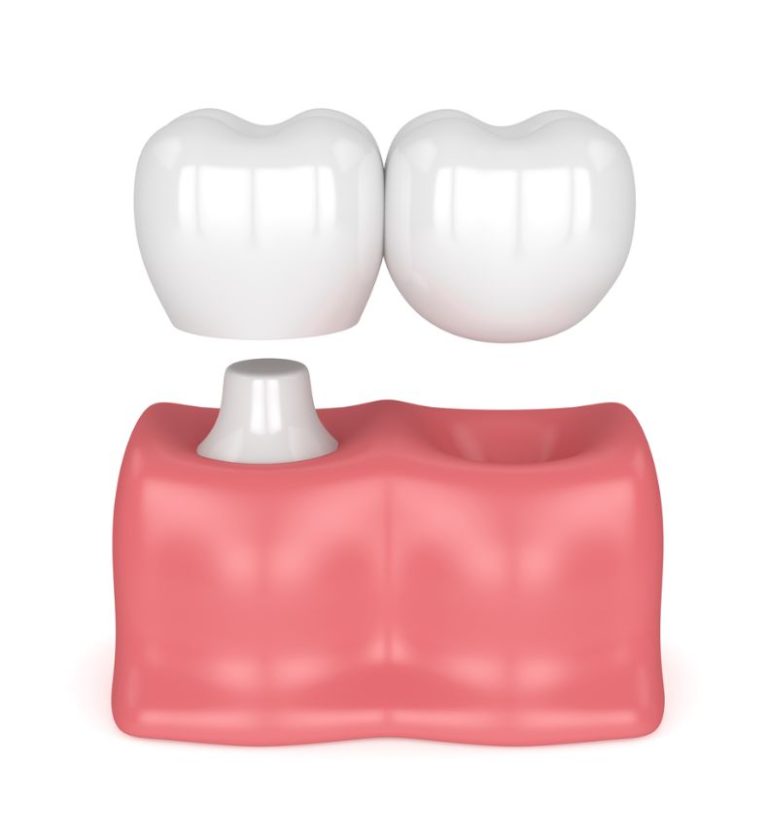 1 Dental Implant for 2 Teeth: Benefits and Costs 2024 - Dentaly.org