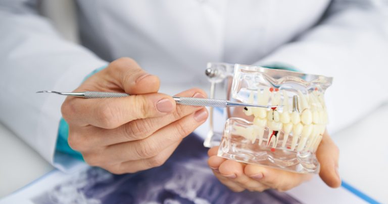Stem Cell Dental Implants to Replace Missing Teeth - Dentaly.org