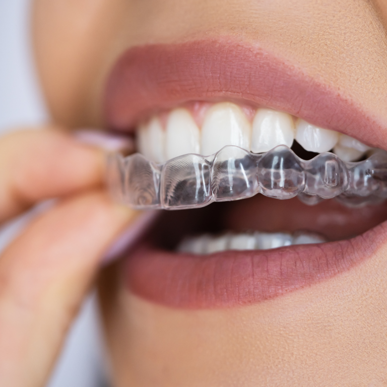 Teeth Retainer: Price, Different Types, and Tips for Cleaning and Wear ...