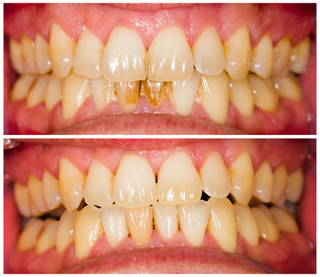 Détartrage des dents : technique et fréquence à adopter
