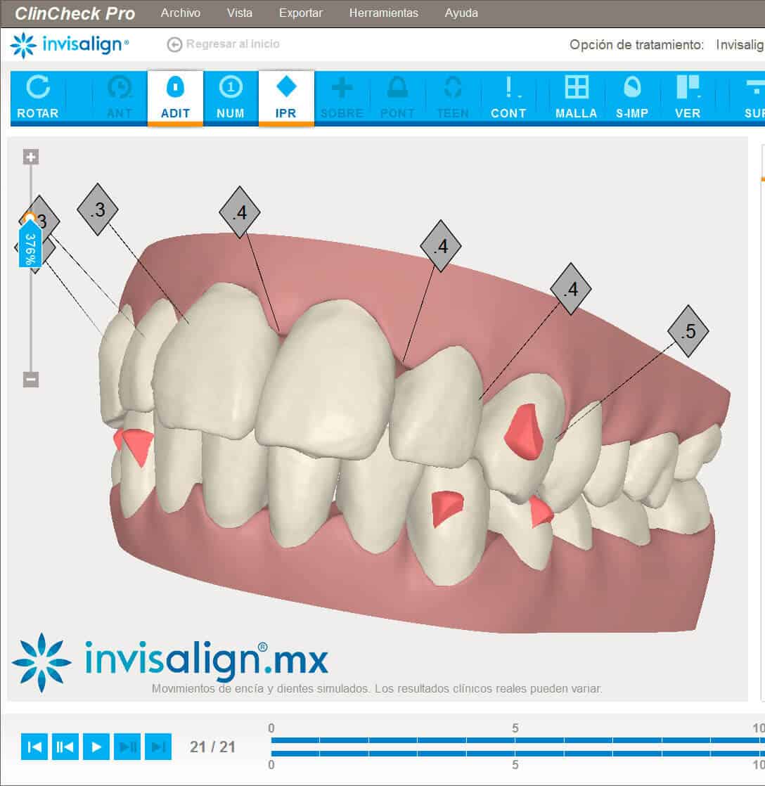 ClinCheck Invisalign : tout savoir sur cette technologie
